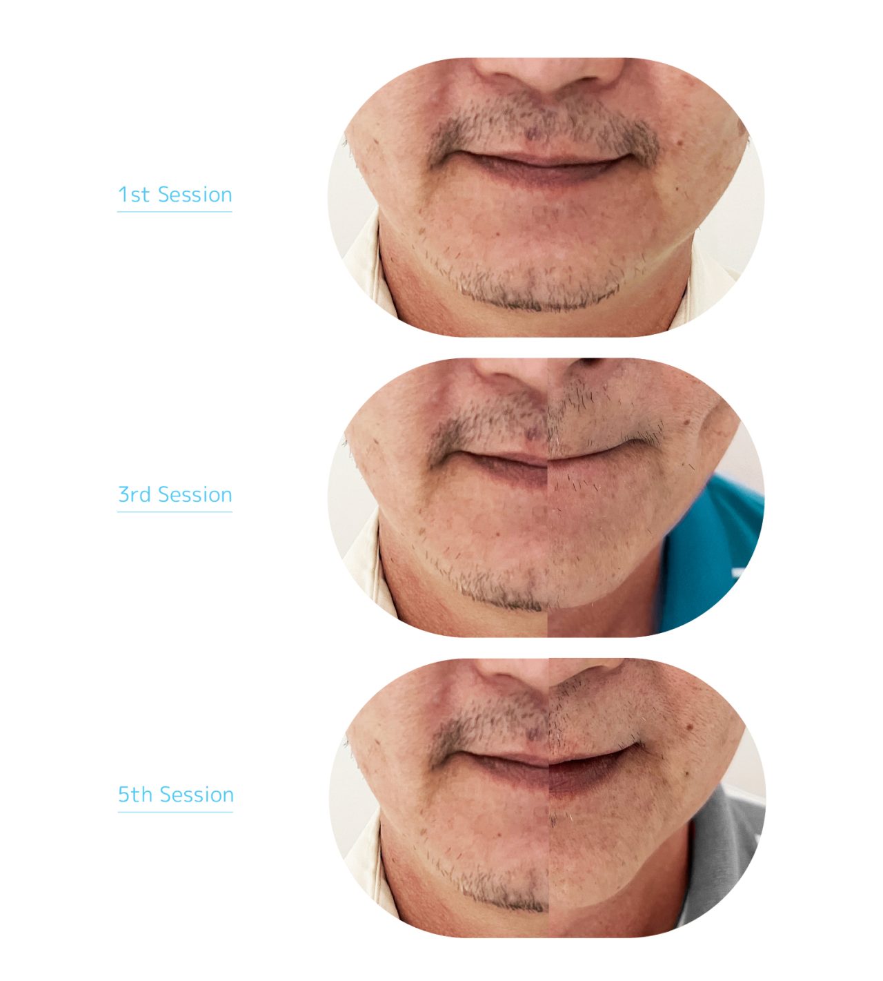 Shine A New Light: ADLight™ - Japan IPL Express